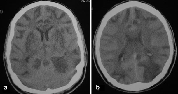 Methanol poisoning: acute MR and CT findings in nine patients ...