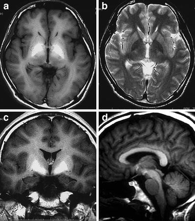 Manganese accumulation in the brain: MR imaging | SpringerLink