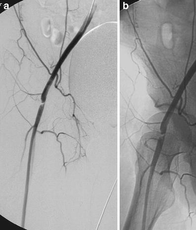 The safety and efficacy of the Angio-Seal closure device in diagnostic ...