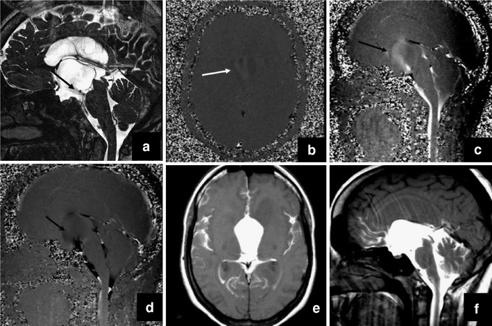 Phase-contrast cine MRI versus MR cisternography on the evaluation of ...
