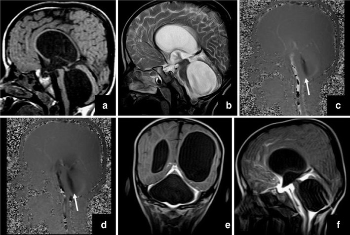 Phase-contrast cine MRI versus MR cisternography on the evaluation of ...