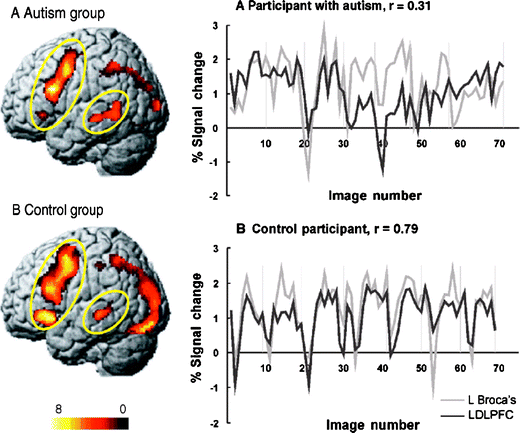 Neuroimaging of autism | SpringerLink