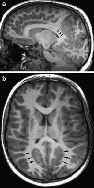 Current concepts of polymicrogyria | SpringerLink