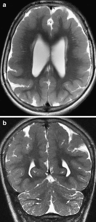 Current concepts of polymicrogyria | SpringerLink