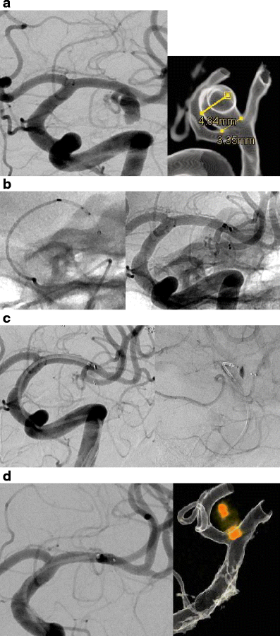 The Woven EndoBridge Cerebral Aneurysm Embolization Device (WEB II ...