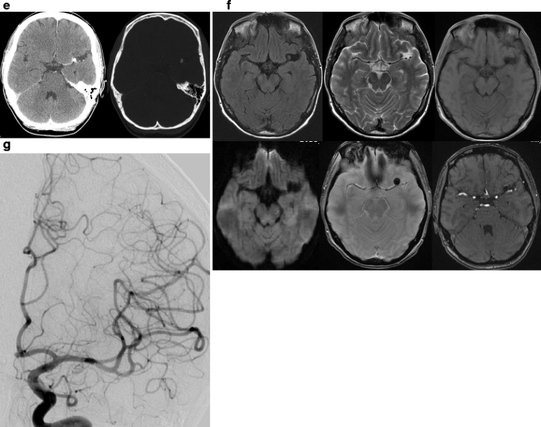 The Woven EndoBridge Cerebral Aneurysm Embolization Device (WEB II ...