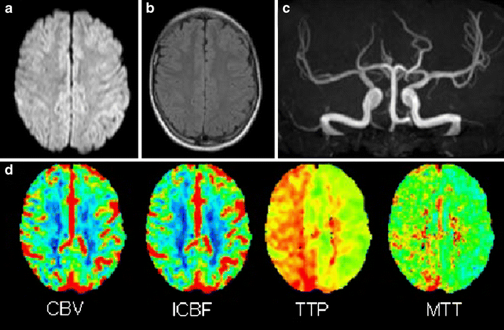 Perfusion-weighted MR imaging in persistent hemiplegic migraine ...