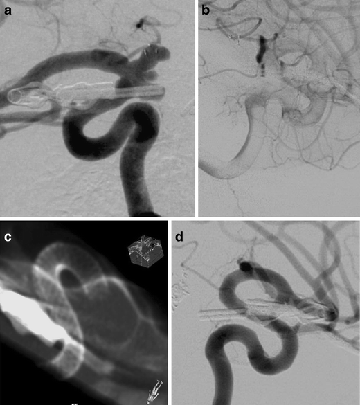 Pipeline embolization device (PED) for neurovascular reconstruction ...