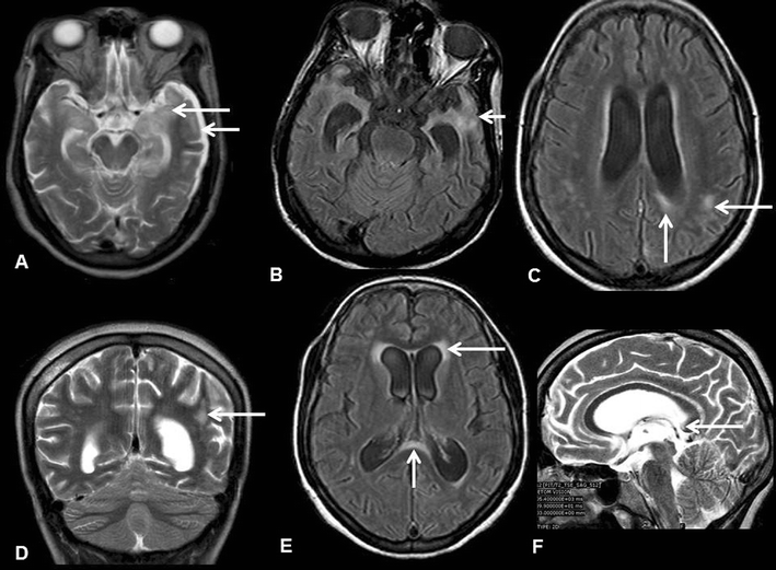 Neurosyphilis: MRI features and their phenotypic correlation in a ...