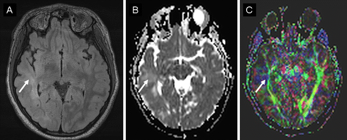 The neuroanatomical phenotype of tuberous sclerosis complex: focus on ...