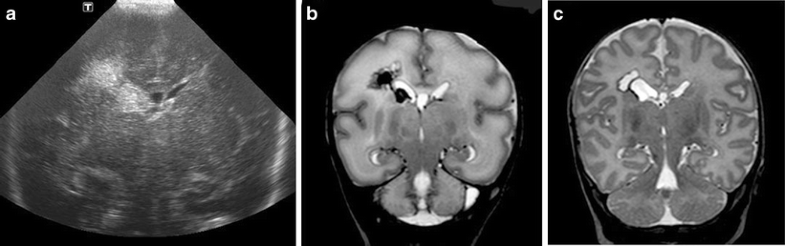 Imaging the premature brain: ultrasound or MRI? | SpringerLink
