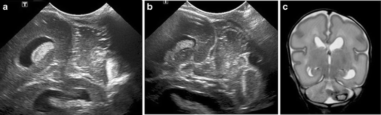 Imaging the premature brain: ultrasound or MRI? | SpringerLink