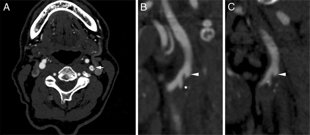Computed tomography angiography intraluminal filling defect is ...