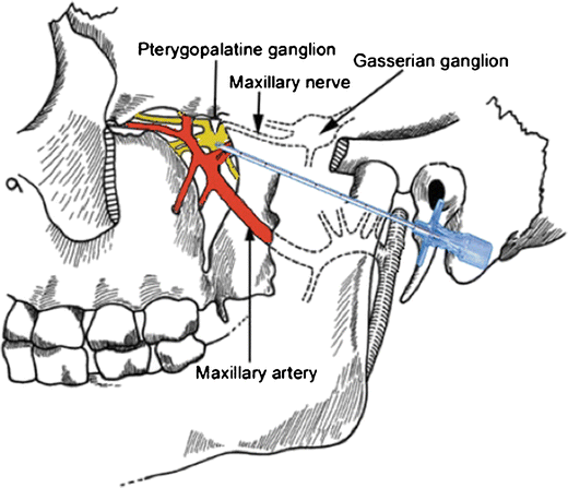 Alcohol percutaneous neurolysis of the sphenopalatine ganglion in the ...