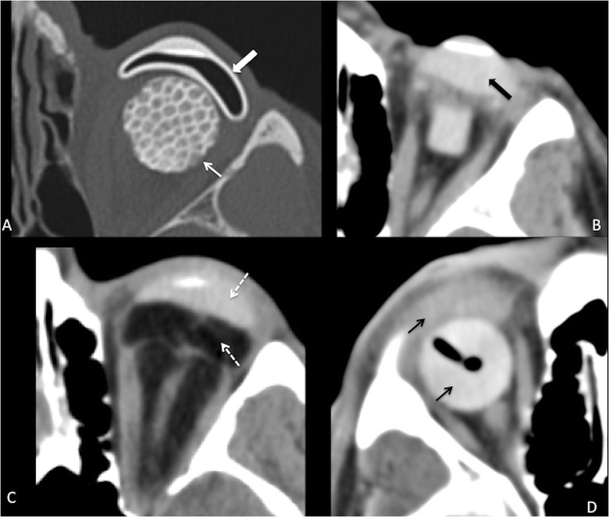 Post-operative orbital imaging: a focus on implants and prosthetic ...