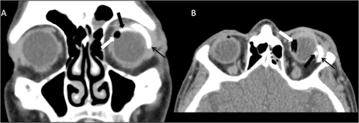 Post-operative orbital imaging: a focus on implants and prosthetic ...
