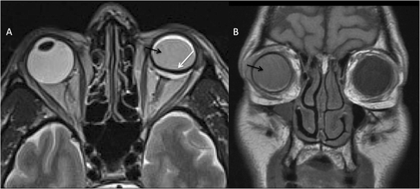 Post-operative orbital imaging: a focus on implants and prosthetic ...