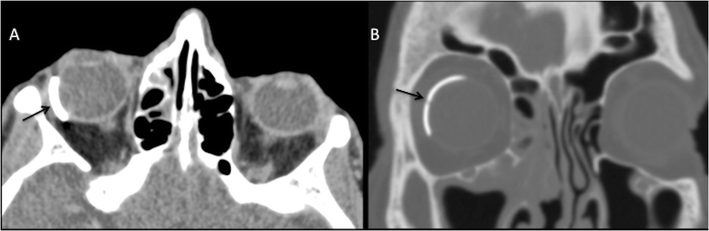 Post-operative orbital imaging: a focus on implants and prosthetic ...