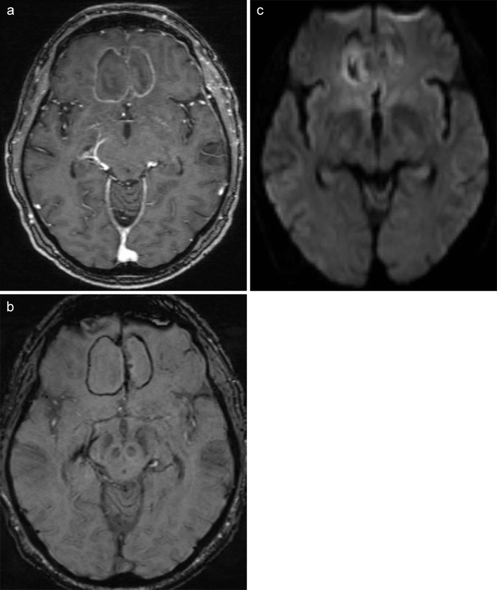 Differentiation of pyogenic and fungal brain abscesses with ...