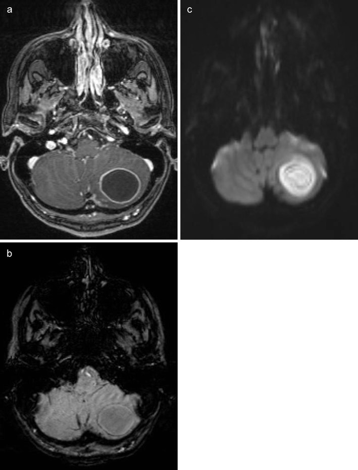 Differentiation of pyogenic and fungal brain abscesses with ...