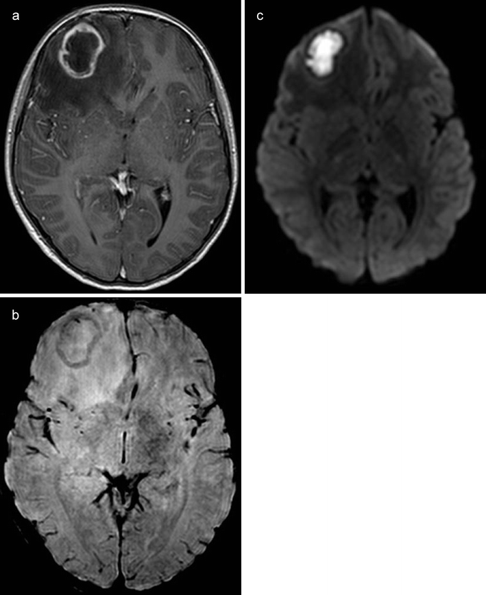 Differentiation of pyogenic and fungal brain abscesses with ...