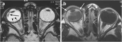 Magnetic resonance imaging of uveitis | SpringerLink
