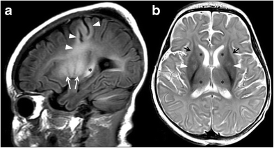 Bilateral symmetrical basal ganglia and thalamic lesions in children ...