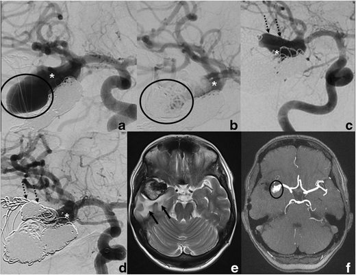 Woven Endobridge (WEB) device for endovascular treatment of complex ...