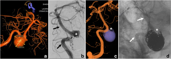 Woven Endobridge (WEB) device for endovascular treatment of complex ...