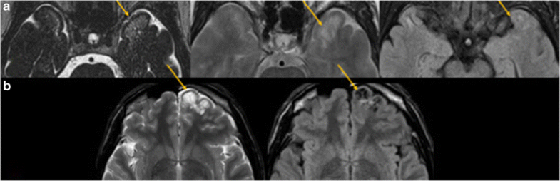 Natural history of lesions with the MR imaging appearance of ...