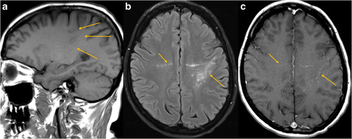 Natural history of lesions with the MR imaging appearance of ...