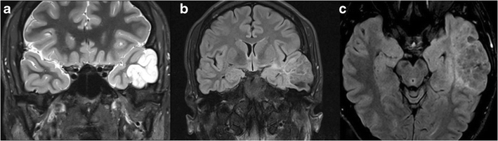 Natural history of lesions with the MR imaging appearance of ...