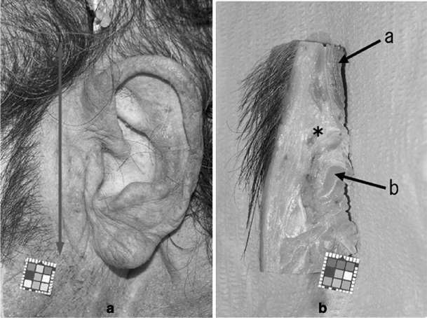 Limited distribution of gravitation abscess caused by infected ...