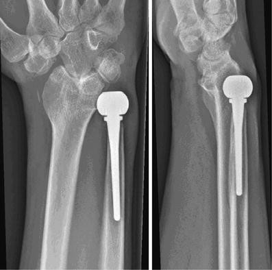 Treatment of post-traumatic degenerative changes of the radio-carpal ...