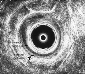 Martius flap: historical and anatomical considerations | SpringerLink