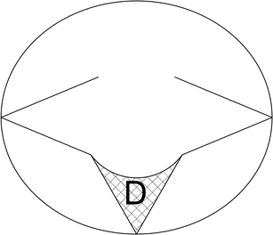Triple-V flap: nipple reconstruction using a modified C-V flap ...