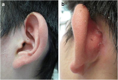 Dual-incision approach for excision of postauricular sinus | SpringerLink