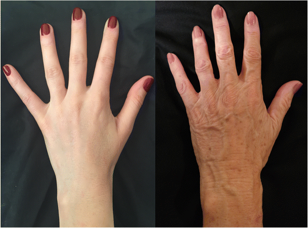 Hand rejuvenation with fat grafting: A 12-year single-surgeon ...