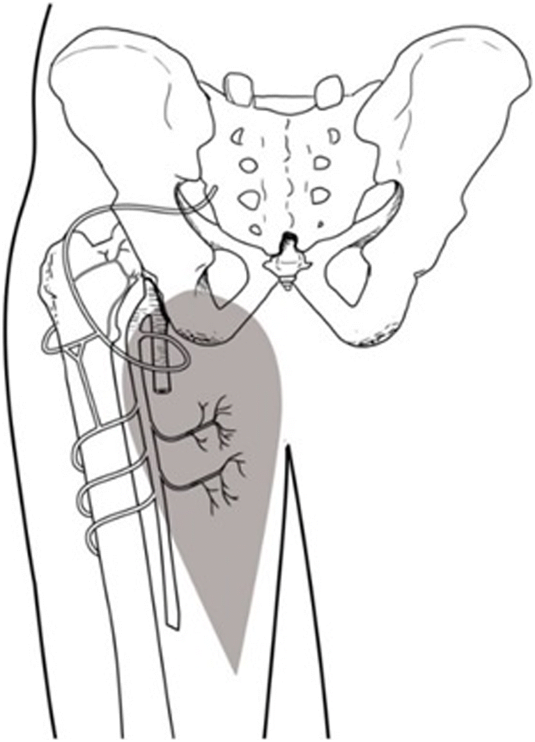 The use of a combined profunda femoris perforator-based fasciocutaneous ...