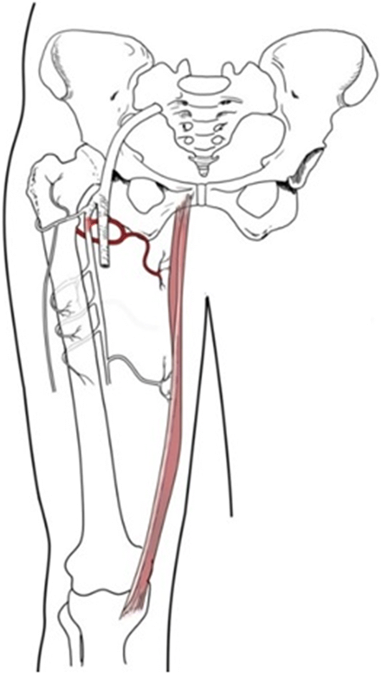 The use of a combined profunda femoris perforator-based fasciocutaneous ...