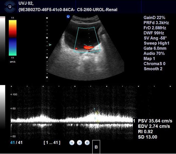 Assessment of ureterovesical jet dynamics in obstructed ureter by ...