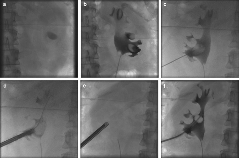 Miniaturisation of PCNL | SpringerLink
