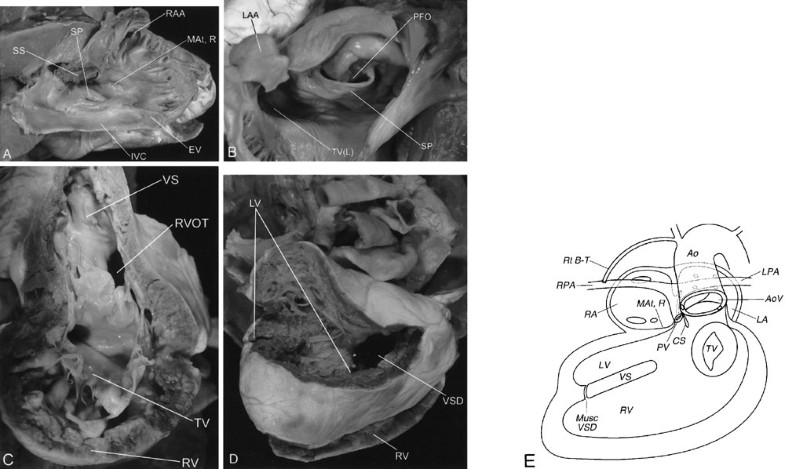 Superoinferior Ventricles with Superior Left Ventricle and Inferior ...