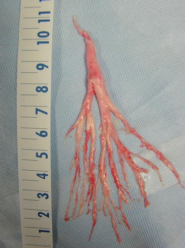 A Case of Plastic Bronchitis Presenting 9 Years After Fontan | SpringerLink