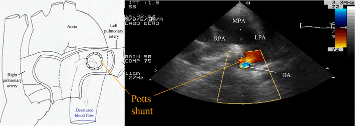 Potts Anastomosis for Children with Idiopathic Pulmonary Hypertension ...