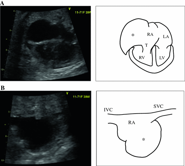 Congenital Aneurysm of the Right Atrial Appendage in a Fetus | SpringerLink