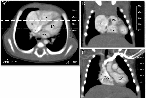 Congenital Aneurysm of the Right Atrial Appendage in a Fetus | SpringerLink