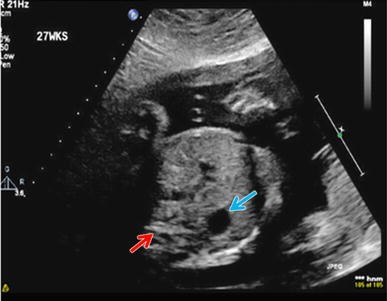 Prenatal Diagnosis of Isolated Levocardia and a Structurally Normal ...