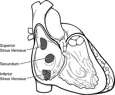 Inferior Sinus Venosus Defects: Anatomic Features and Echocardiographic ...