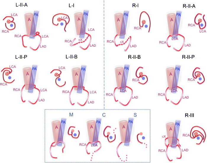 Single Coronary Artery Anomaly: Classification and Evaluation Using ...